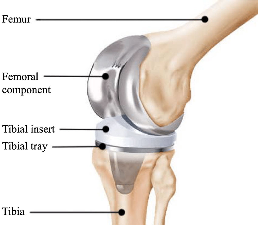 Knee Replacement Lawsuits Implant Failures Knee Replacement Lawsuits Implant Failures